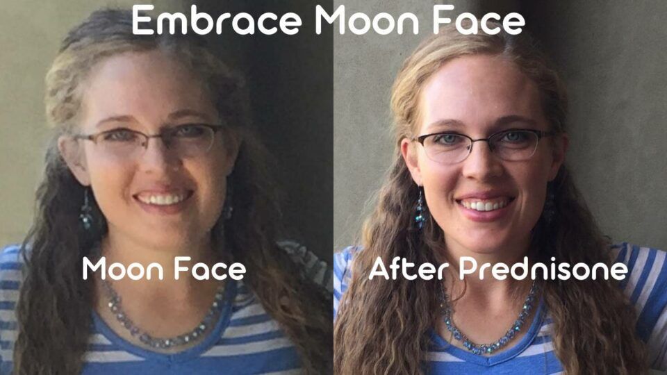 Embrace and Reduce Moon Face | Dr. Megan Side Effects & Solutions