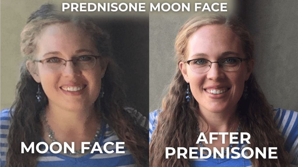9+ Worst Side Effects of Prednisone | Dr. Megan